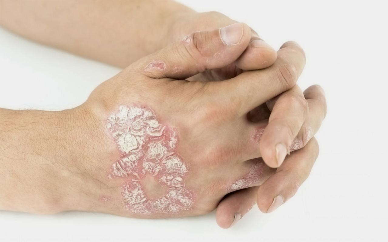 Snail Slime, natural remedy for psoriasis